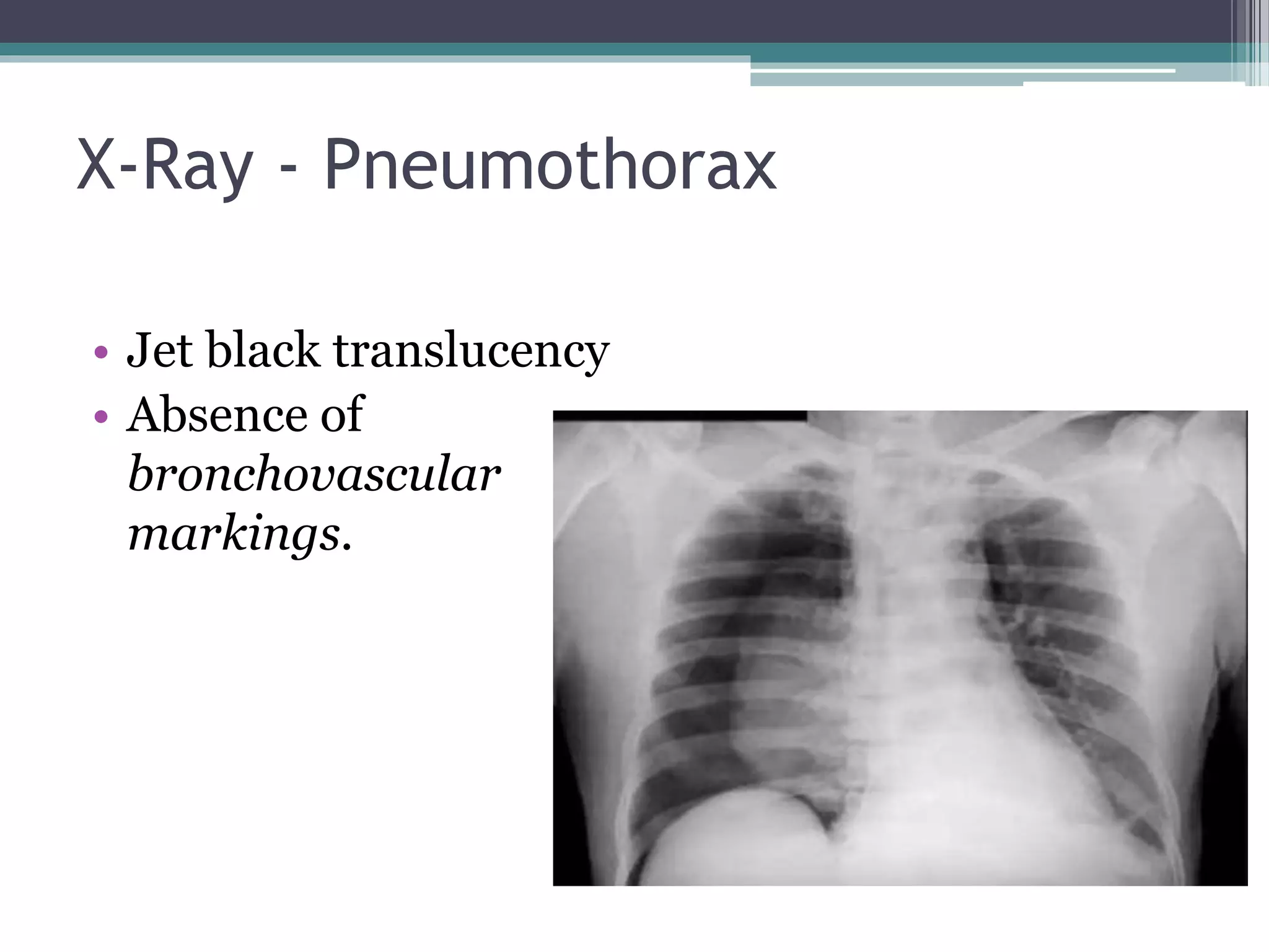 Imaging In Pneumothorax Pptx
