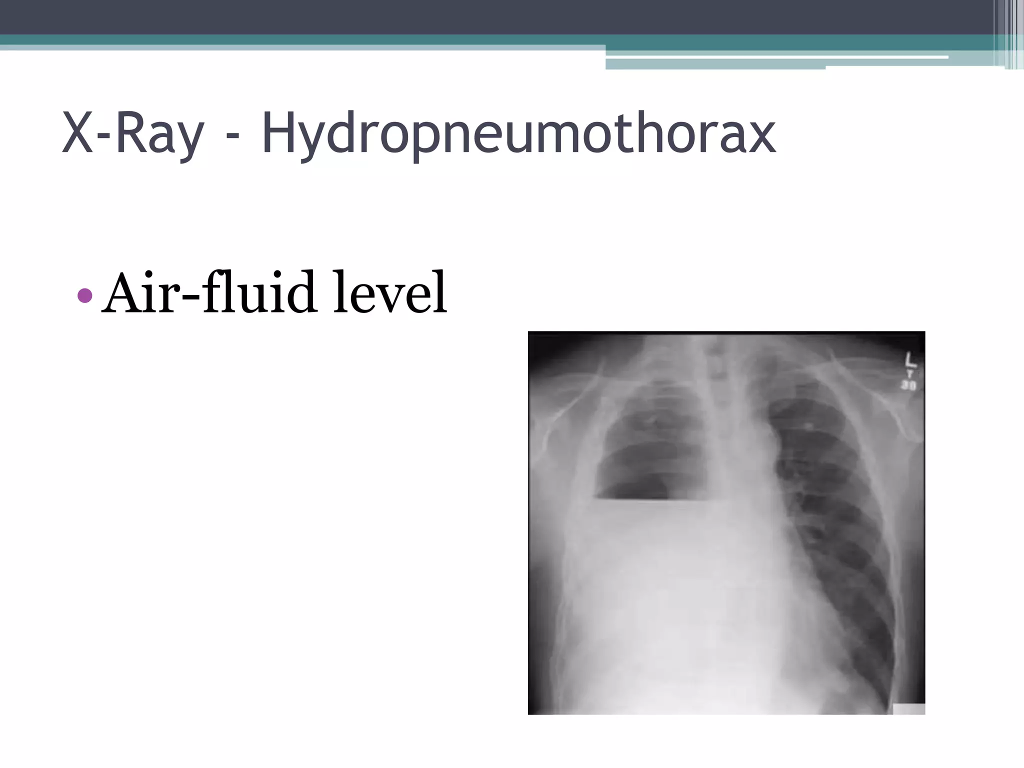 Imaging in pneumothorax.pptx