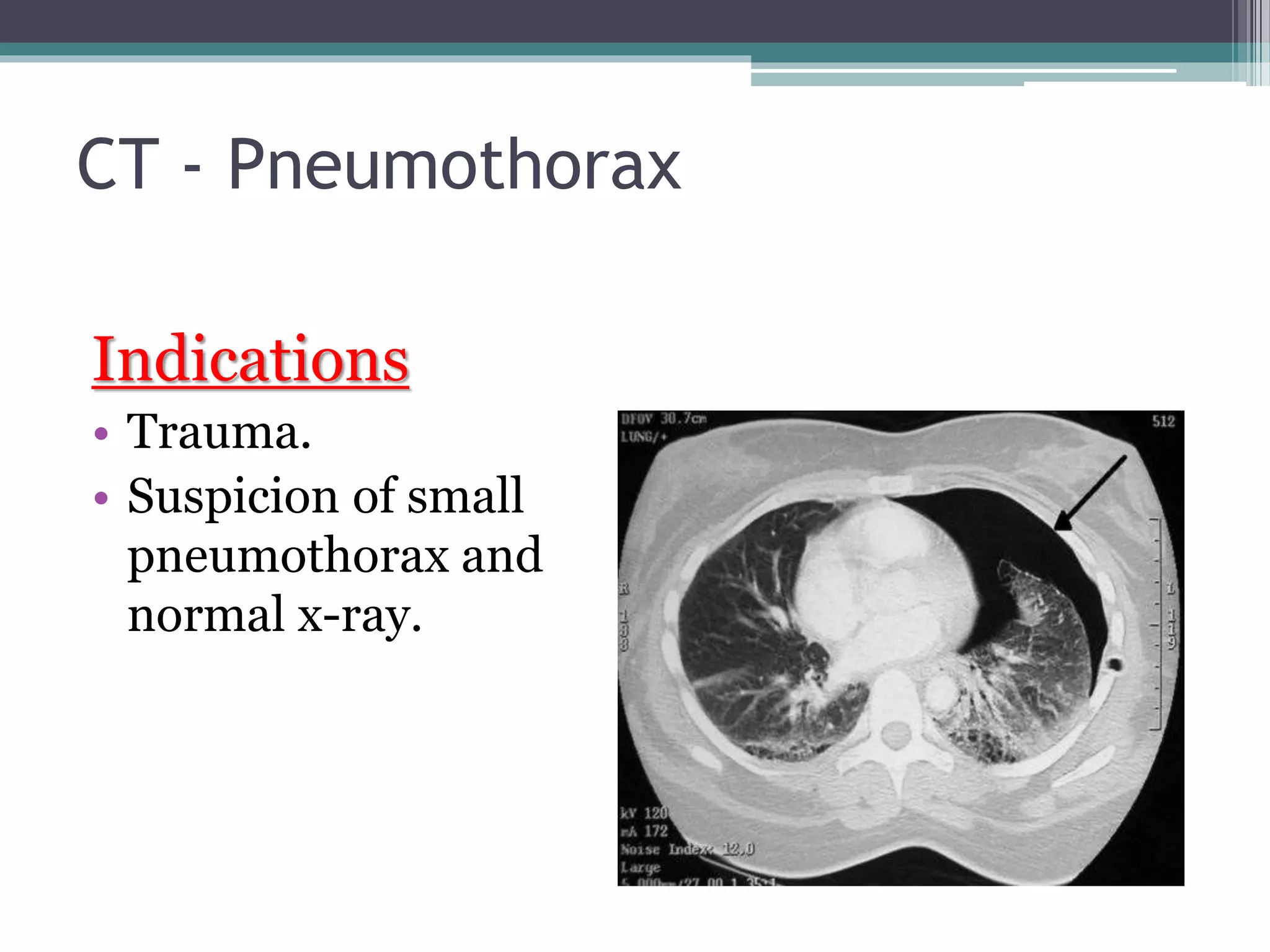 Imaging in pneumothorax.pptx