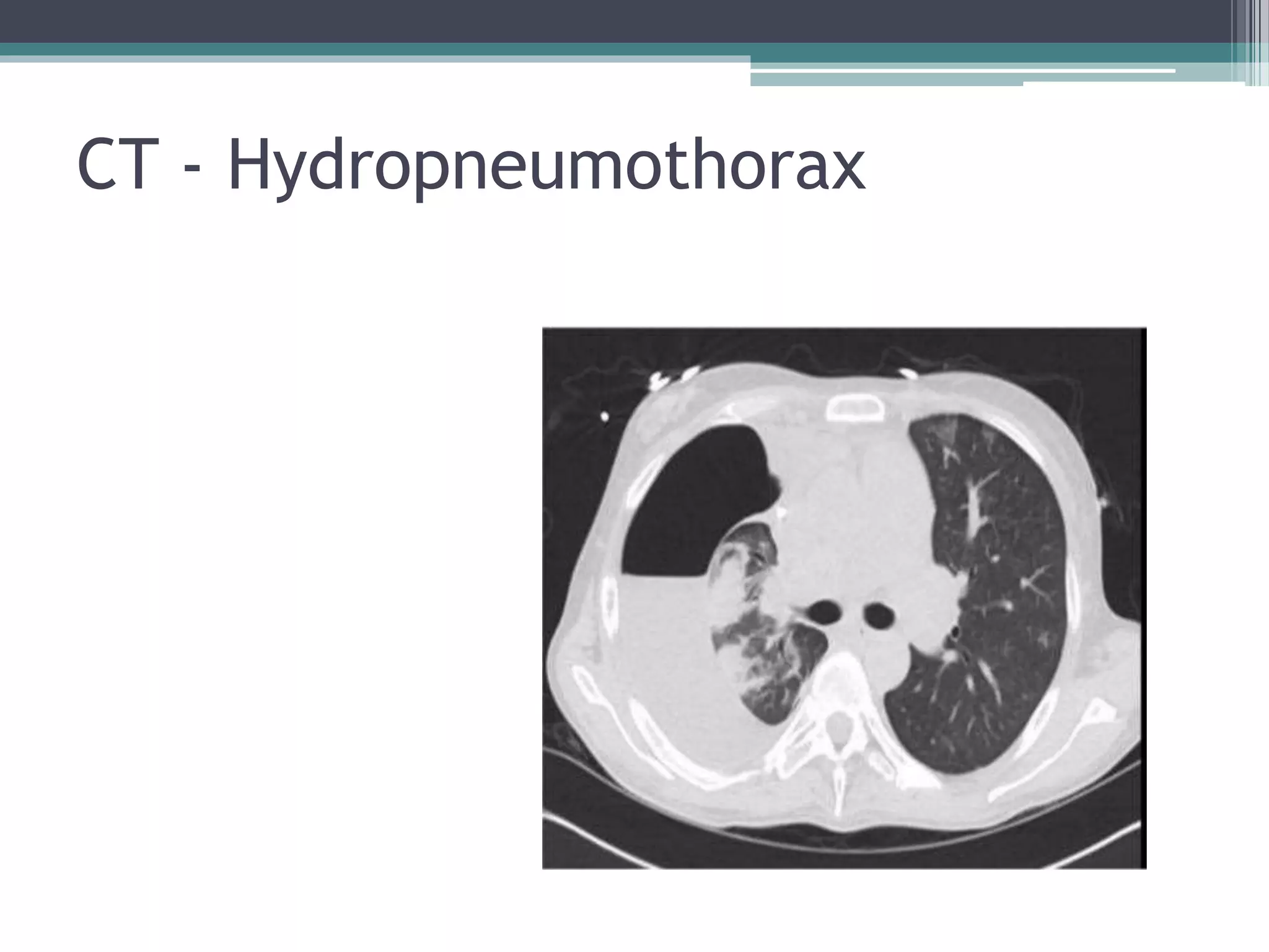 Imaging In Pneumothorax Pptx