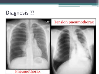 Imaging in pneumothorax.pptx