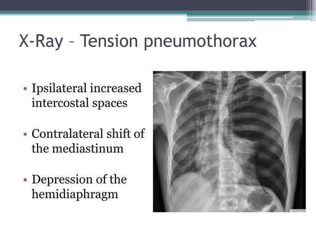 Imaging In Pneumothorax Pptx