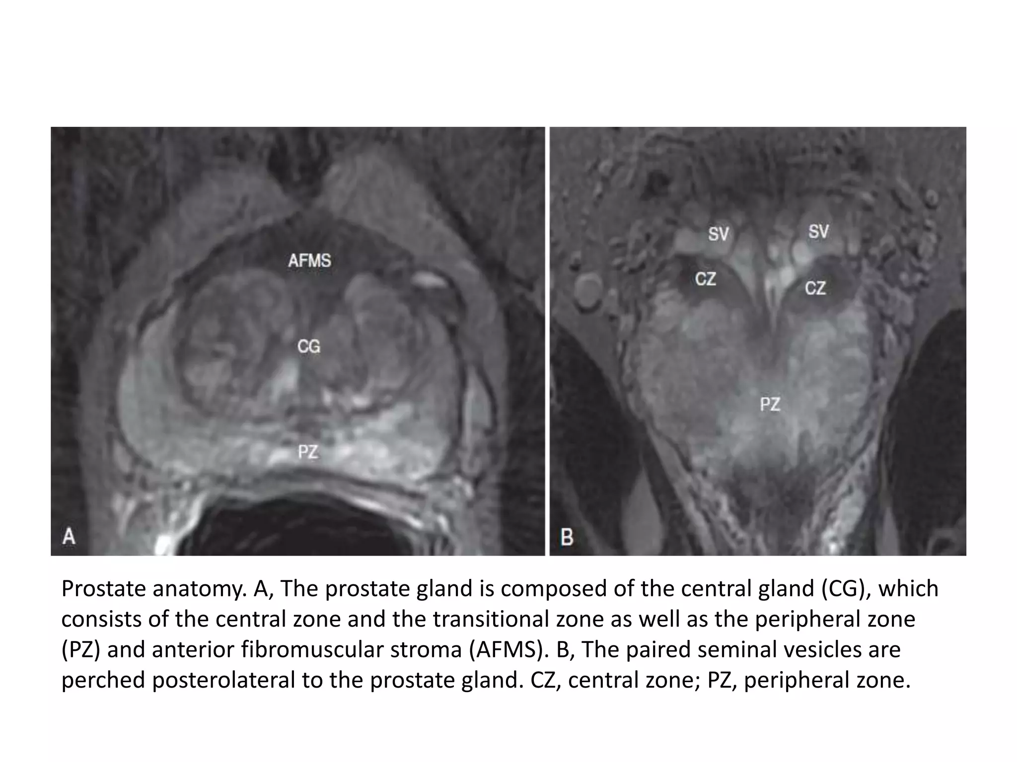Imaging in prostatic patholgy | PPTX