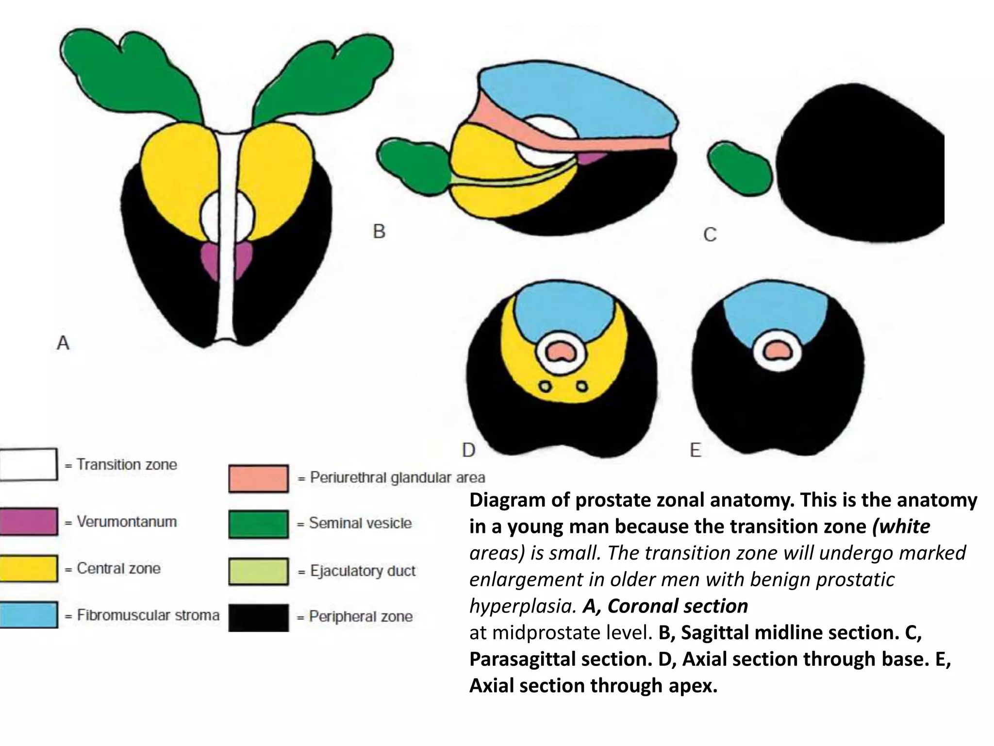 Imaging in prostatic patholgy | PPTX