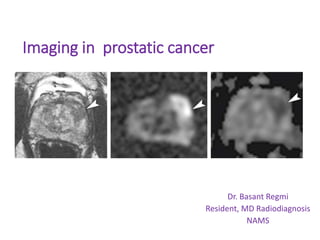 Imaging in prostatic patholgy | PPT