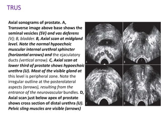Imaging in prostatic patholgy | PPTX