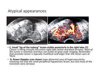 Imaging in prostatic patholgy | PPTX