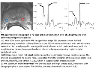Imaging in prostatic patholgy | PPTX