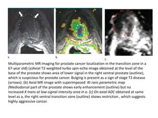 Imaging in prostatic patholgy | PPTX