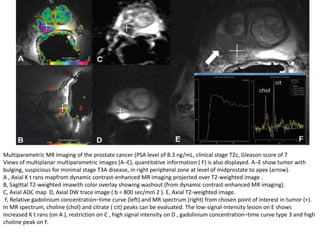 Imaging in prostatic patholgy | PPTX