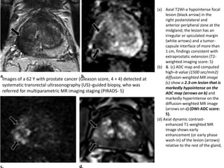 Imaging in prostatic patholgy | PPTX