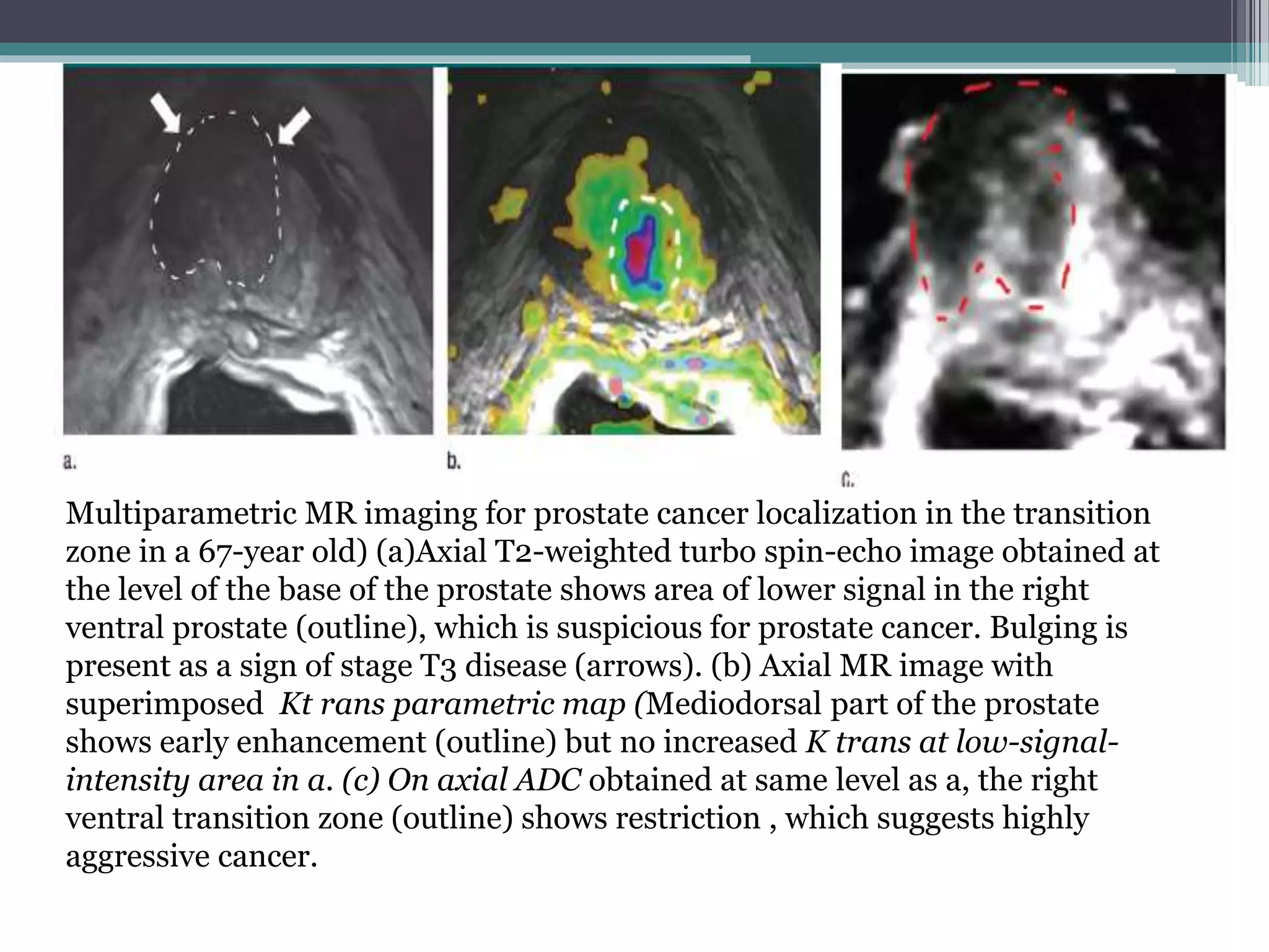 Imaging in prostatic patholgy | PPTX | Endocrine and Metabolic Diseases ...