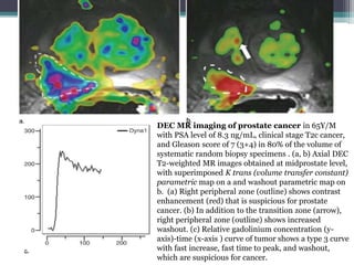 Imaging in prostatic patholgy | PPTX