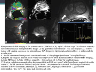 Imaging in prostatic patholgy | PPTX