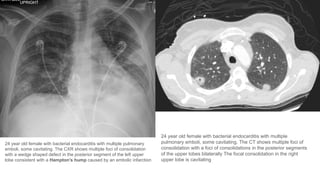 IMAGING IN PULMONARY THROMBOIMBOLISM.pptx