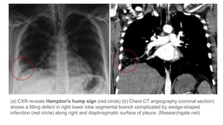 IMAGING IN PULMONARY THROMBOIMBOLISM.pptx