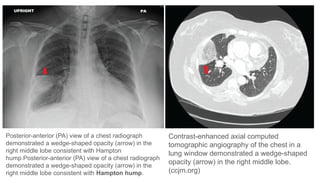 IMAGING IN PULMONARY THROMBOIMBOLISM.pptx