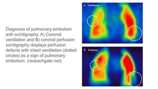 IMAGING IN PULMONARY THROMBOIMBOLISM.pptx