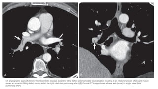 IMAGING IN PULMONARY THROMBOIMBOLISM.pptx