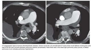 IMAGING IN PULMONARY THROMBOIMBOLISM copy 11.pptx