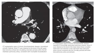 IMAGING IN PULMONARY THROMBOIMBOLISM copy 11.pptx