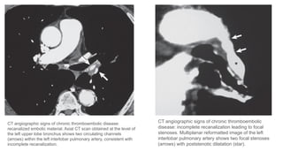 IMAGING IN PULMONARY THROMBOIMBOLISM copy 11.pptx