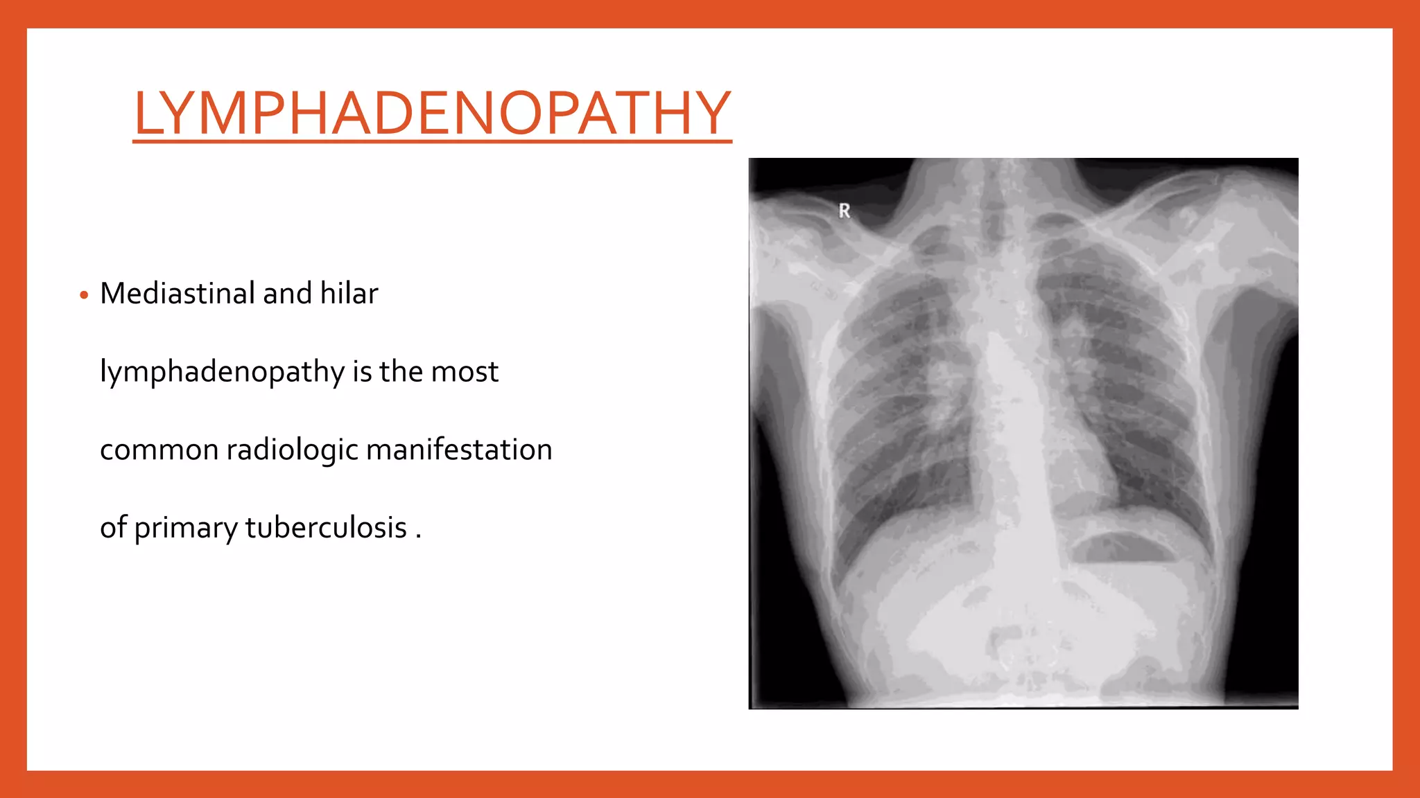 Imaging in pulmonary tuberculosis | PPTX