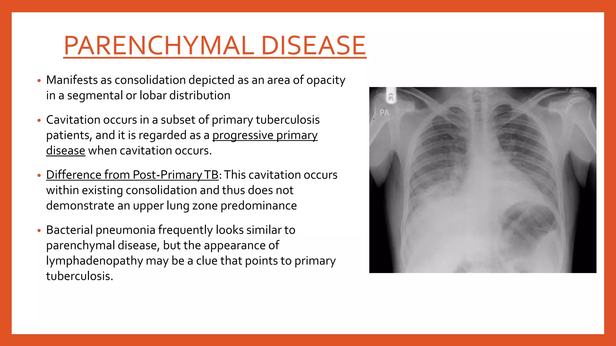 Imaging in pulmonary tuberculosis | PPTX