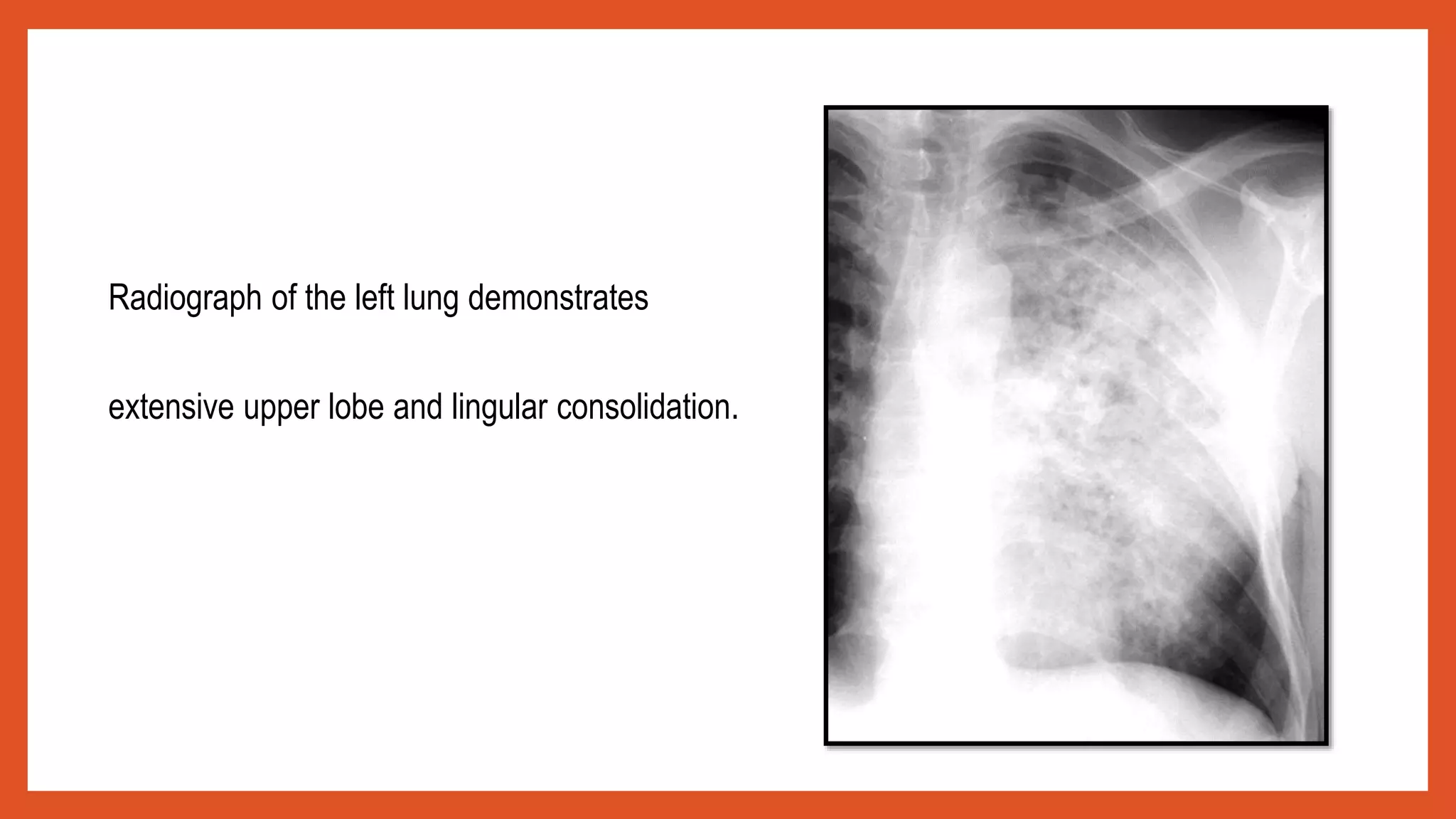 Imaging in pulmonary tuberculosis | PPTX