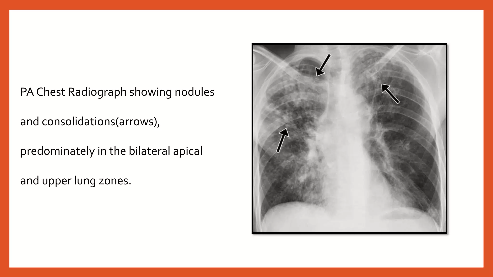Imaging in pulmonary tuberculosis | PPTX