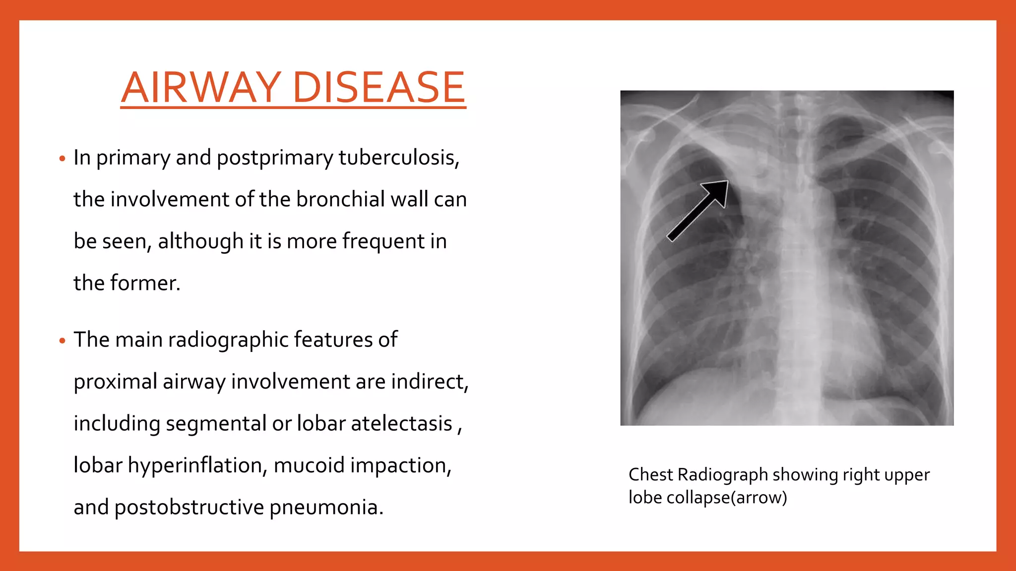 Imaging in pulmonary tuberculosis | PPTX