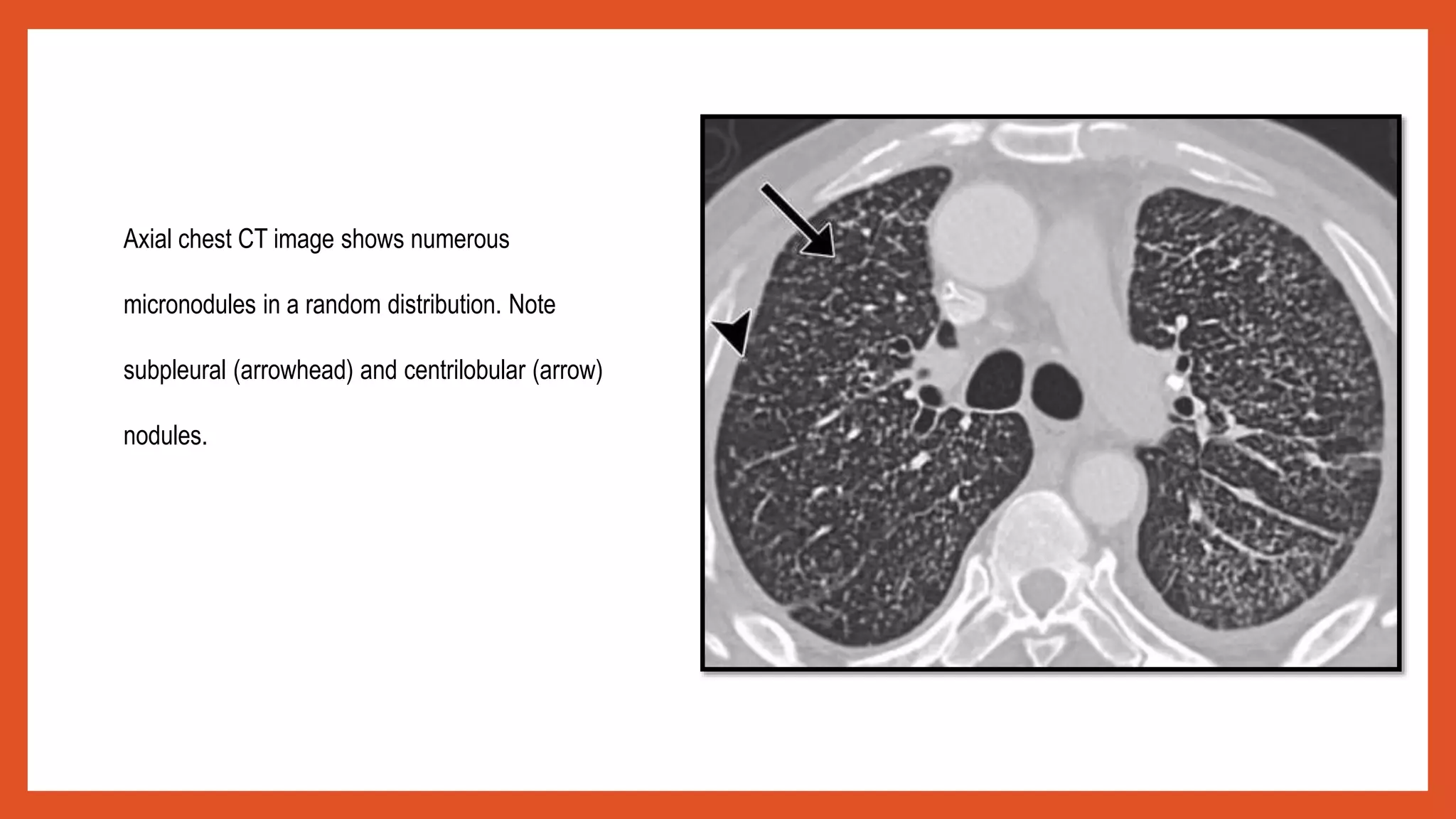 Imaging in pulmonary tuberculosis | PPTX