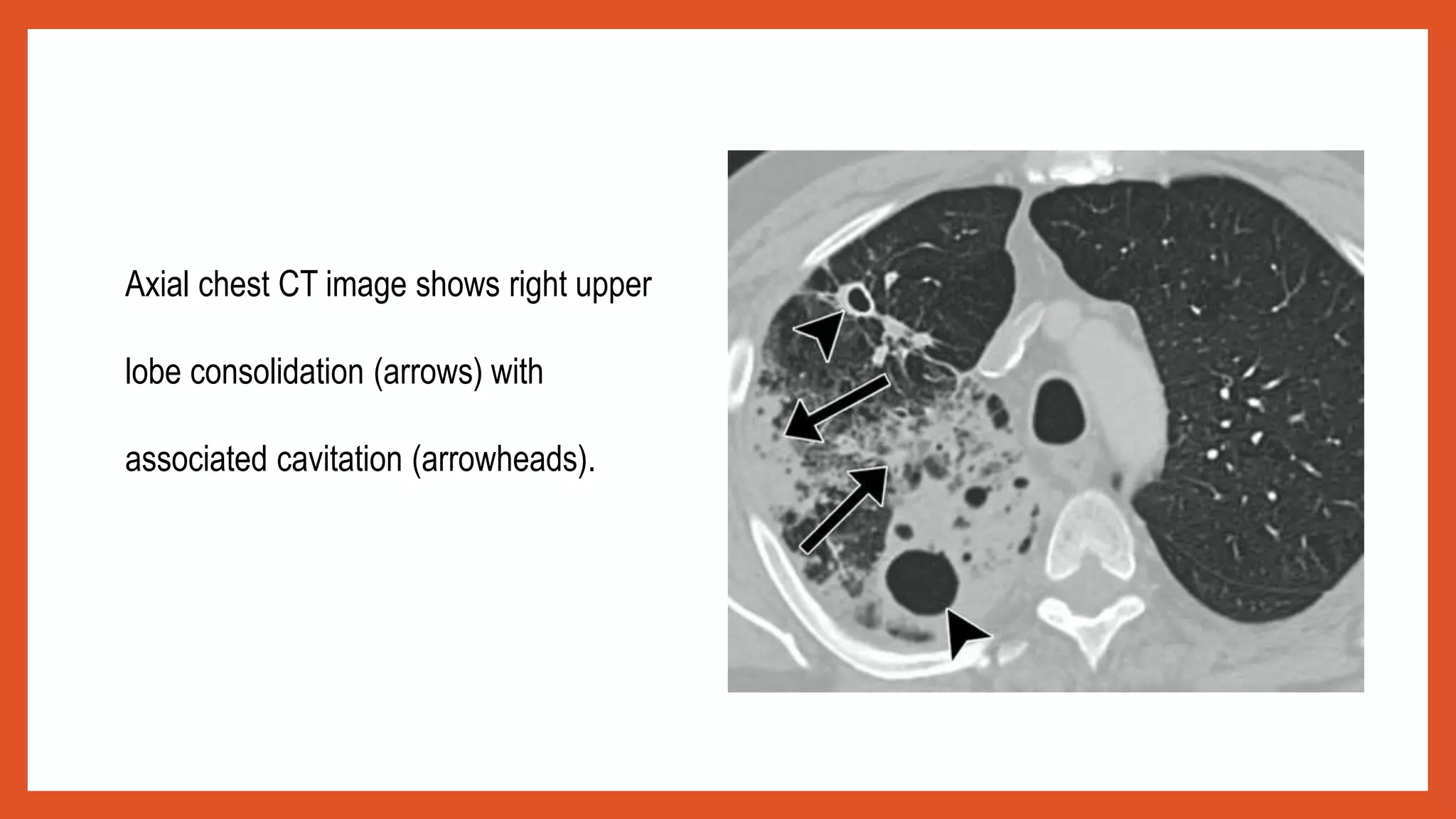Imaging in pulmonary tuberculosis | PPTX