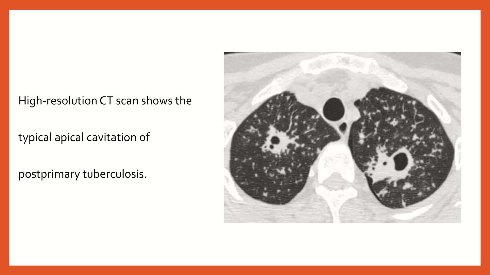 Imaging in pulmonary tuberculosis | PPTX
