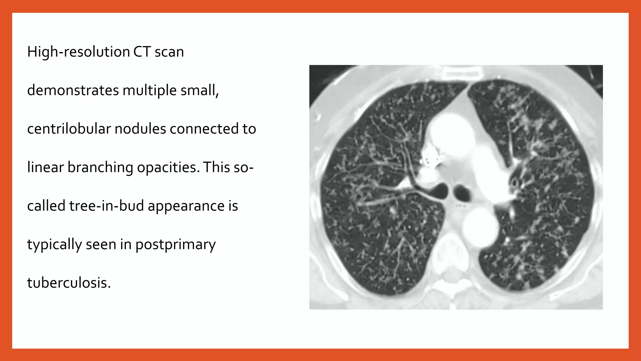 Imaging in pulmonary tuberculosis | PPTX