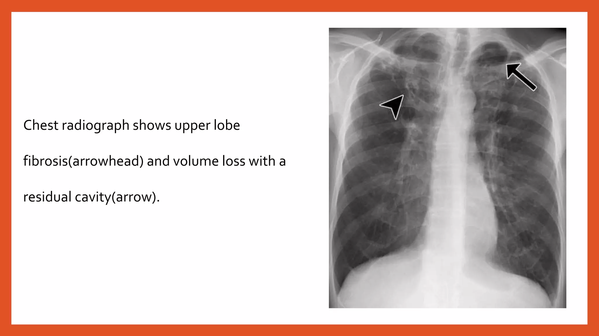 Imaging in pulmonary tuberculosis | PPTX