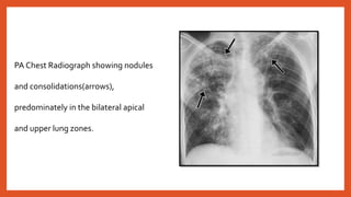 Imaging in pulmonary tuberculosis | PPTX