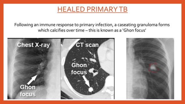 Imaging in pulmonary tuberculosis | PPTX | Infectious Diseases ...