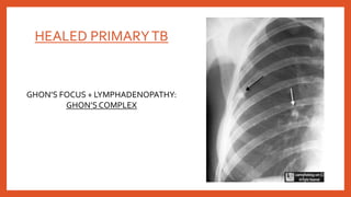 Imaging in pulmonary tuberculosis | PPTX