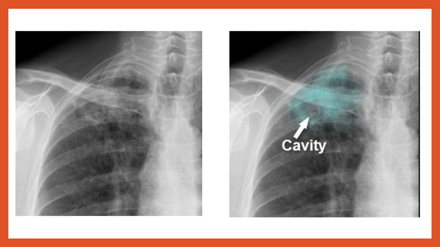 Imaging in pulmonary tuberculosis | PPTX | Infectious Diseases ...