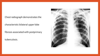 Imaging in pulmonary tuberculosis | PPTX