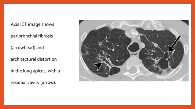 Imaging in pulmonary tuberculosis | PPTX | Infectious Diseases ...
