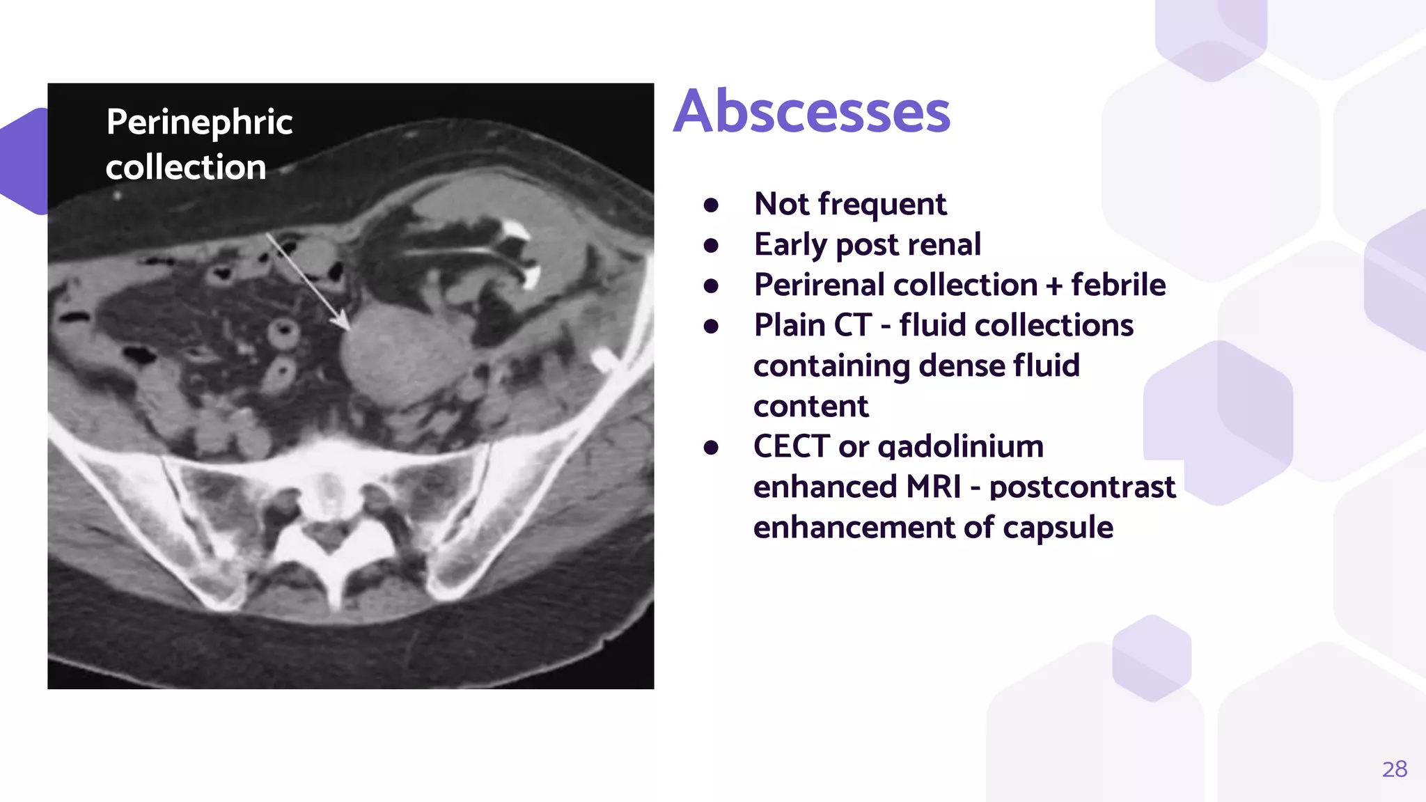 Imaging in renal transplant | PPTX