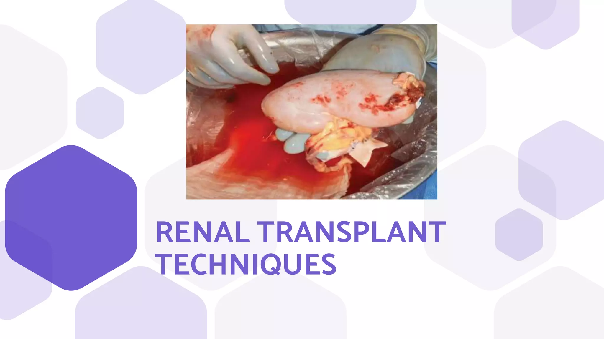 Imaging in renal transplant | PPTX