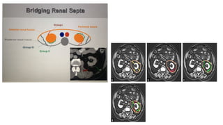 Imaging in retroperitoneum presentation. | PPTX
