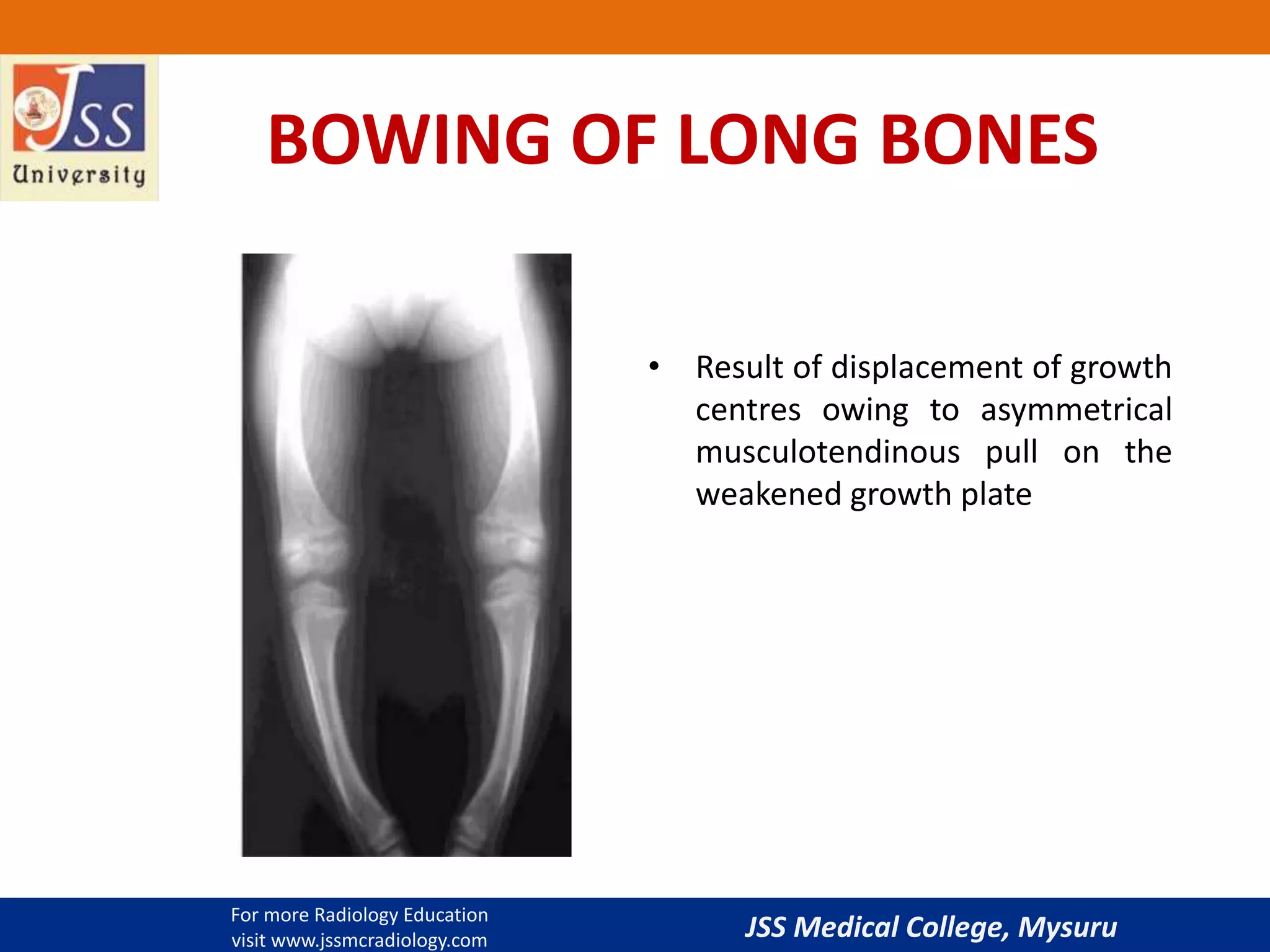Imaging in rickets | PPTX