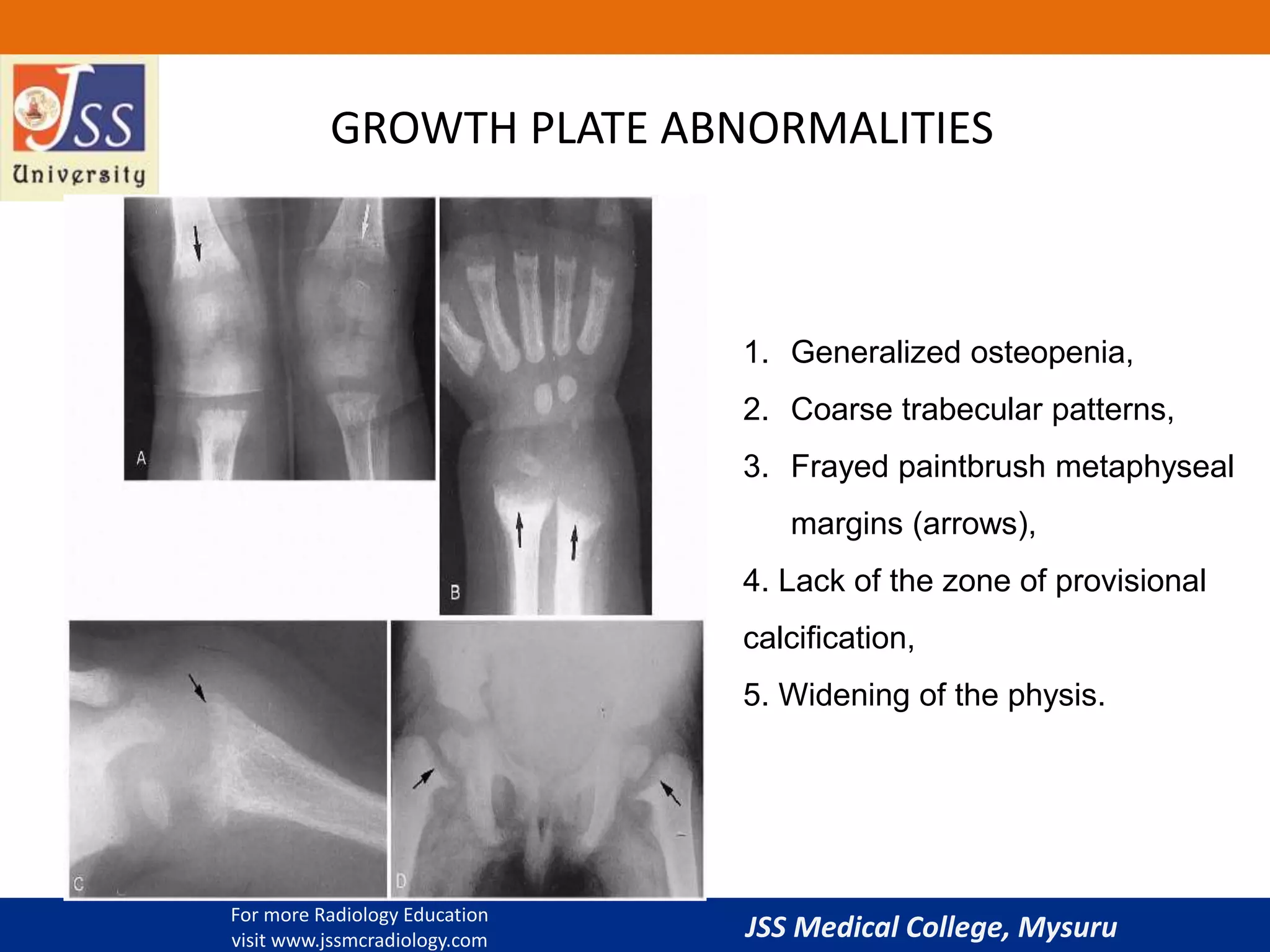 Imaging in rickets | PPTX