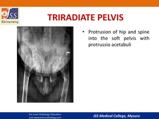 Triradiate Pelvis Osteomalacia