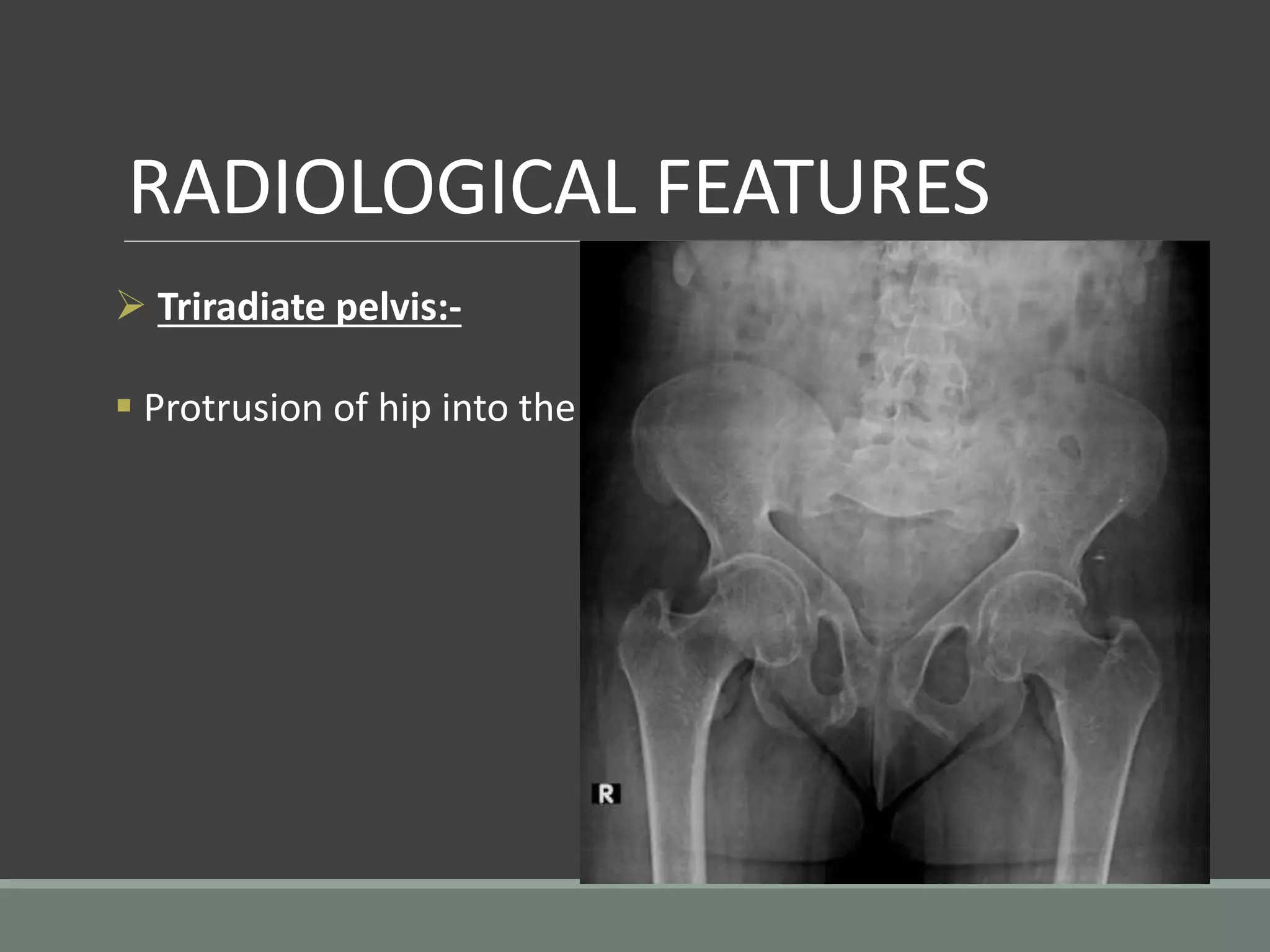Imaging in rickets | PPTX