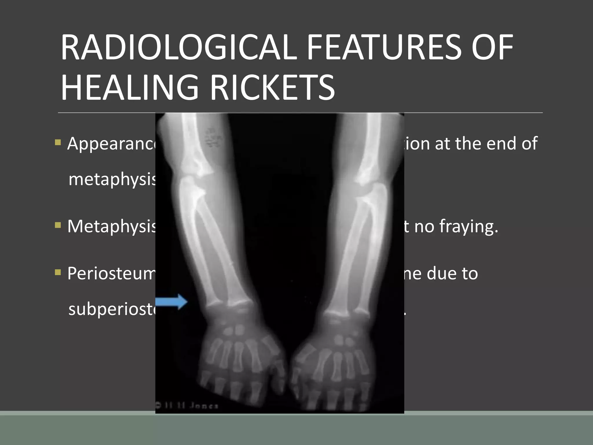 Imaging in rickets | PPTX